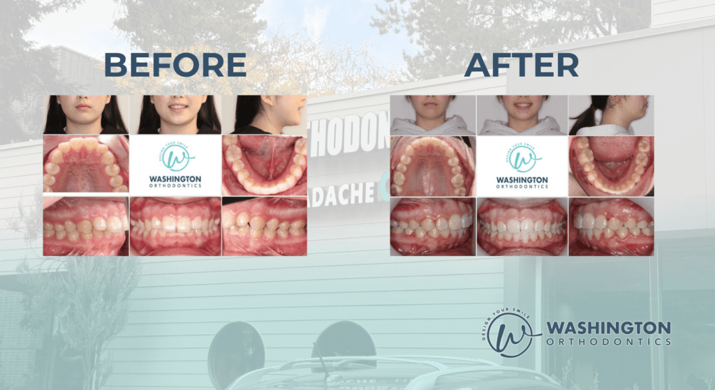 Deep Bite Correction with Braces in Bellevue