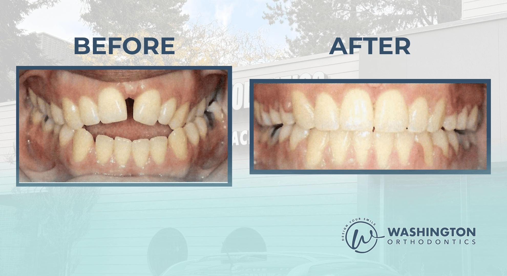 Open Bite Correction with Braces: What to Expect in Bellevue