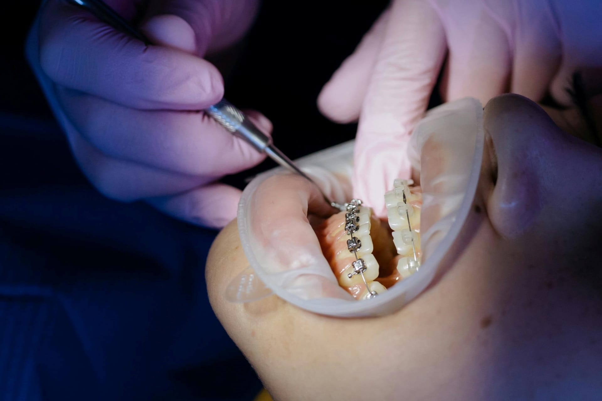 Do Braces Fix Overbite Issues? Here's What You Need To Know